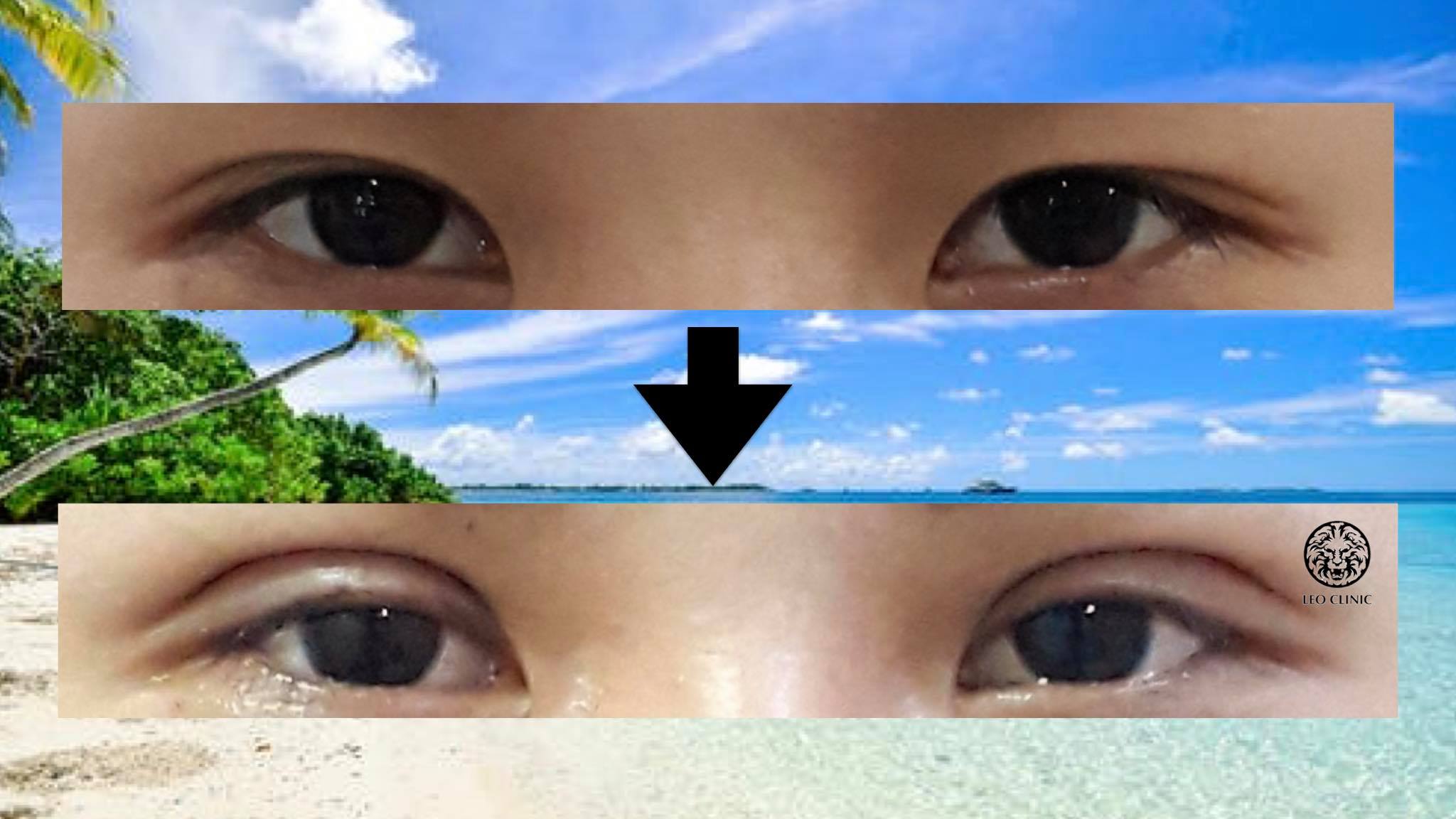 Double eyelids – LEO CLINIC